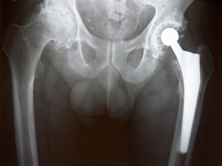 Stryker Hip Replacement Lawyer in Florida | Free Consultation