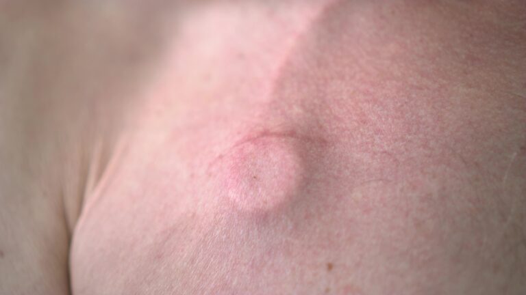 Bard Power Port Lawsuit (April 2025 Update) | Dolman Law Group